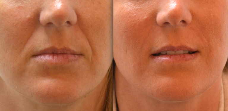 Sillons nasogéniens - Docteur Schinazi